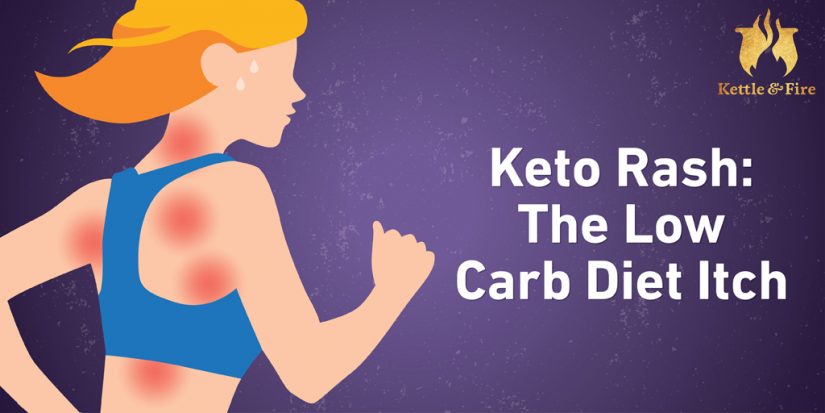 Keto Rash: The Low Carb Diet Itch